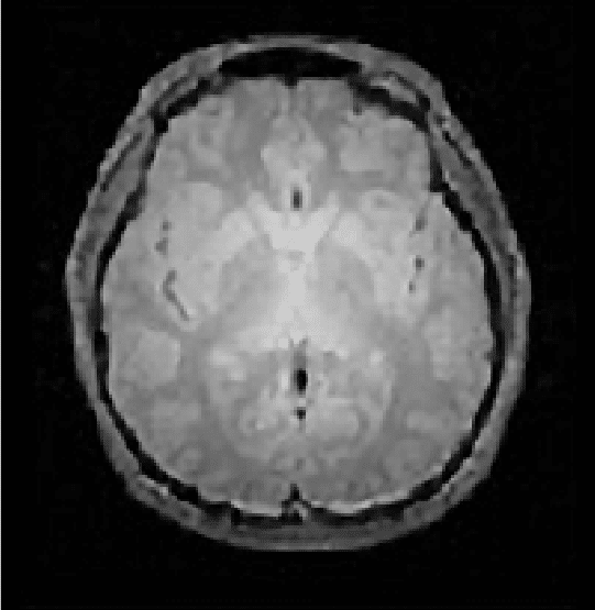 Neuroimaging In Multiple Sclerosis - Perceptive | Science-Led Clinical ...